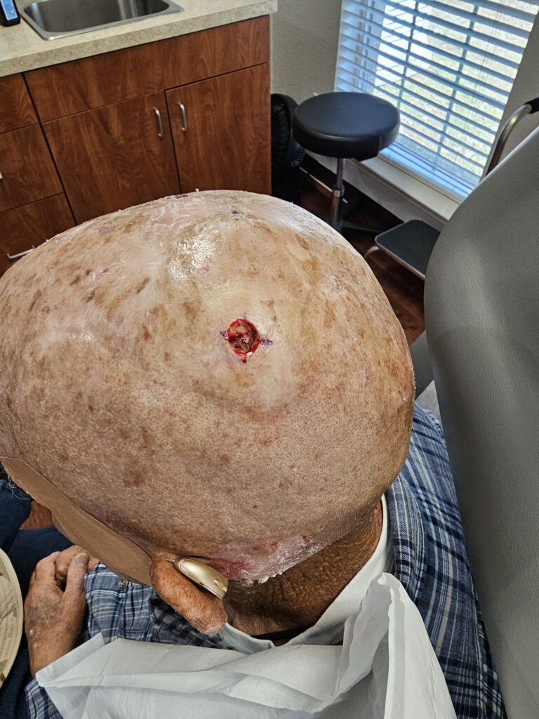 Here I Sit - Henry Feeser's Peritoneal Dialysis (PD) journey